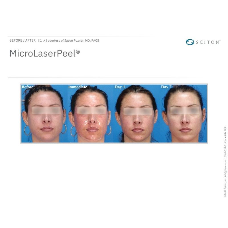 Sciton Microlaser Peel & Profractional | Restore by King Dermatology | Mountain Home, AR