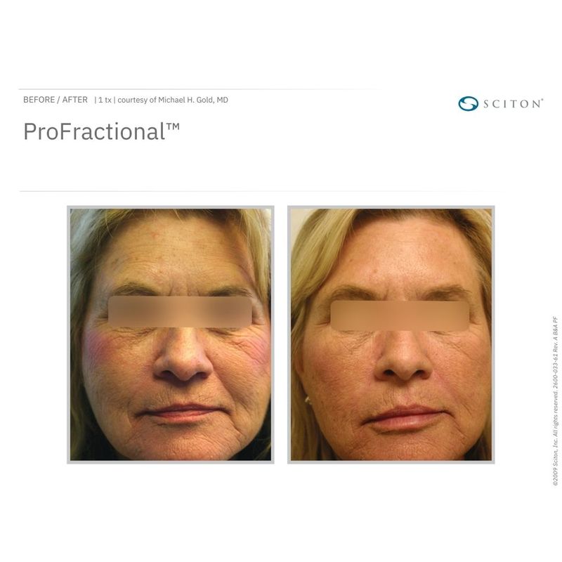 Sciton Microlaser Peel & Profractional | Restore by King Dermatology | Mountain Home, AR