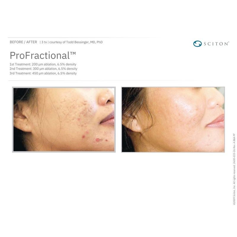 Sciton Microlaser Peel & Profractional | Restore by King Dermatology | Mountain Home, AR