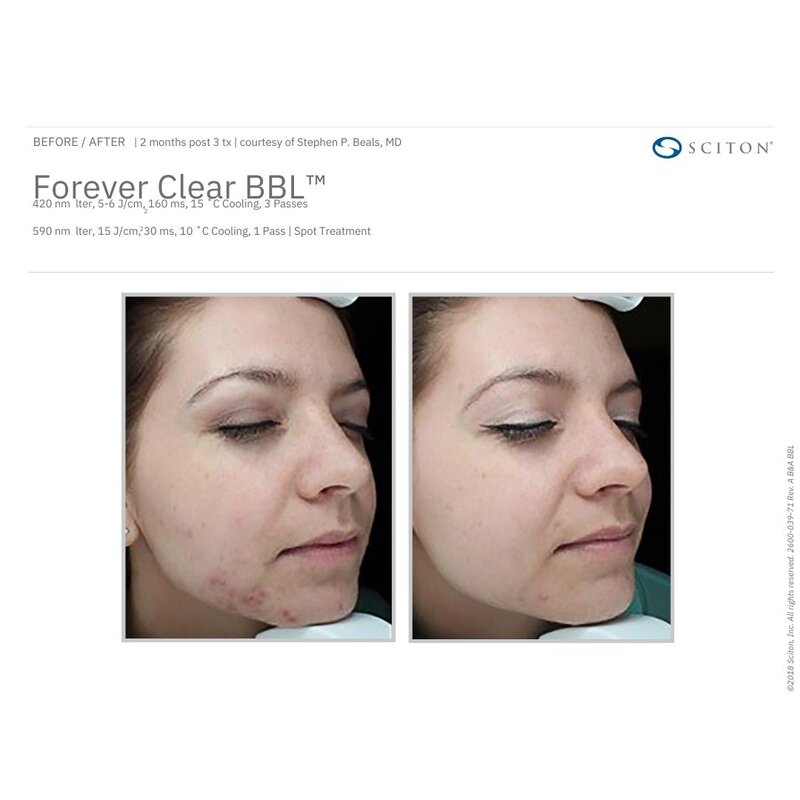 BBL FOREVER CLEAR | Restore by King Dermatology | Mountain Home, AR