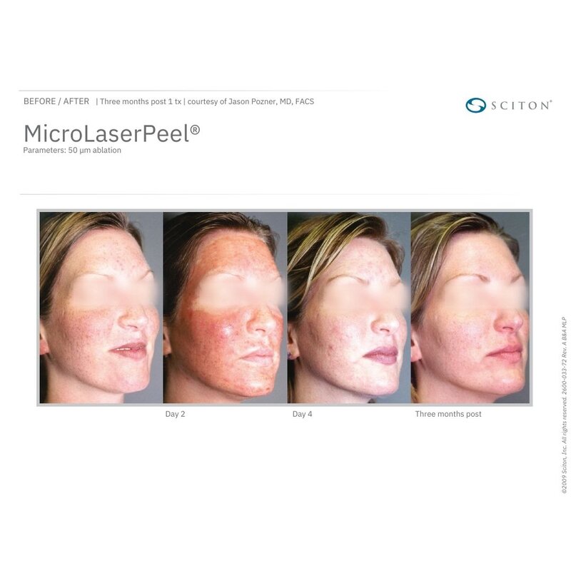 Sciton Microlaser Peel & Profractional | Restore by King Dermatology ...